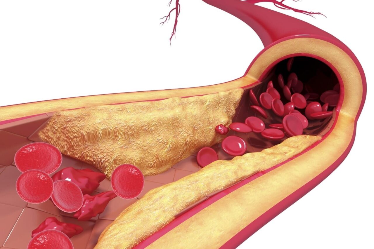 Symptoms And Consequences Of Atherosclerosis Tci Hospital En