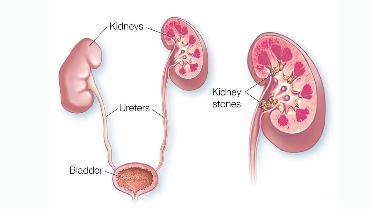 Urolithiasis - Causes and Remedies - TCI Hospital EN