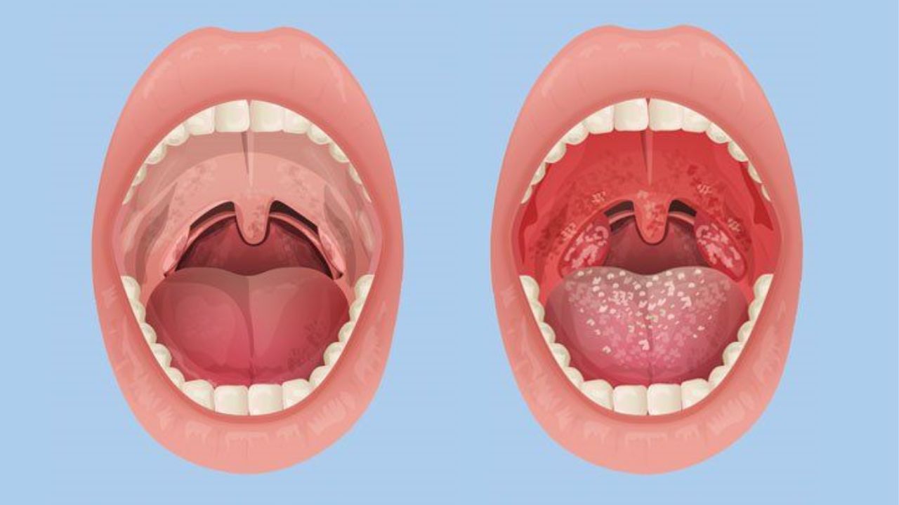 Comprehensive Information On Tonsillitis Tci Hospital En