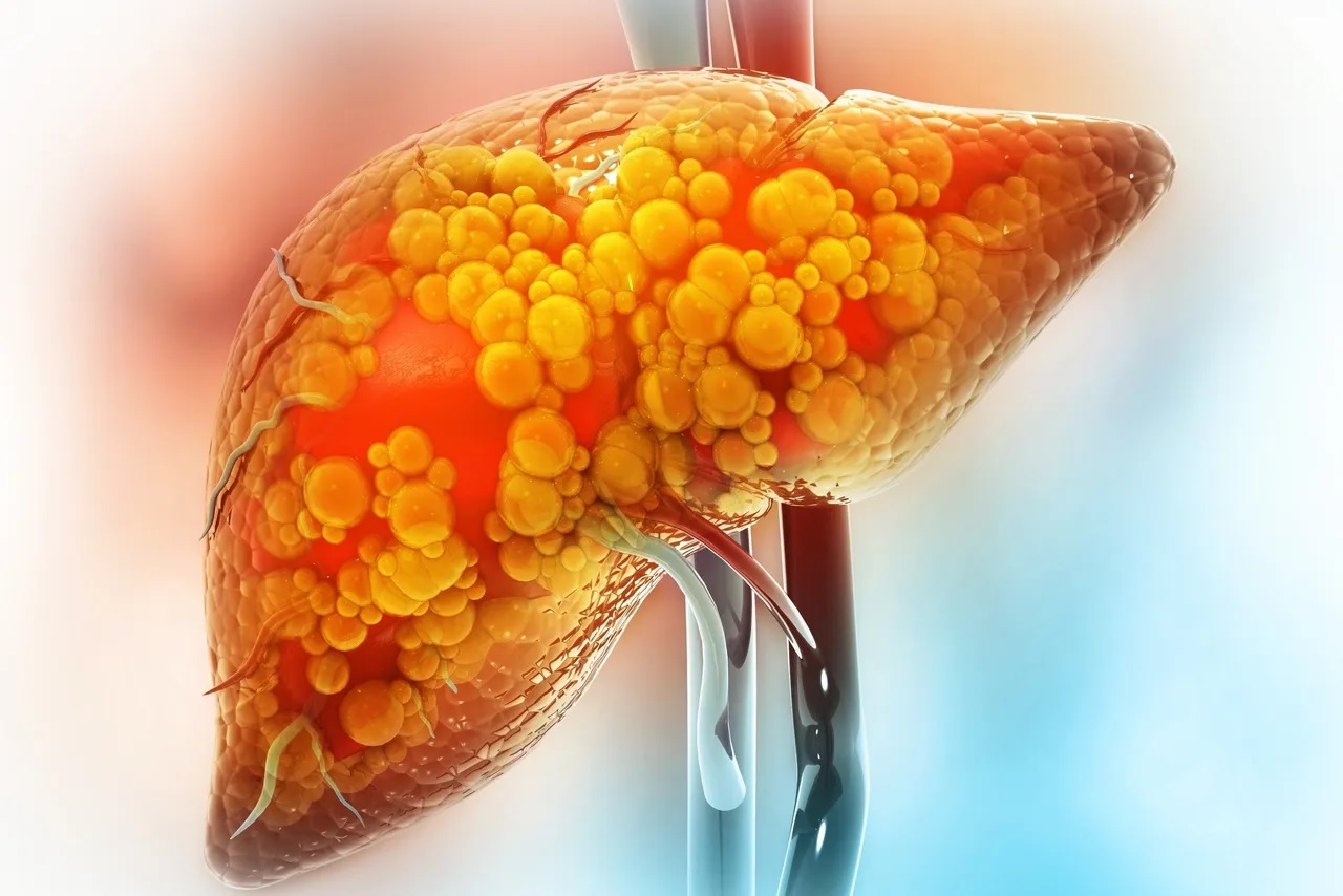 Understanding Fatty Liver Disease: Causes and Treatment - TCI Hospital EN