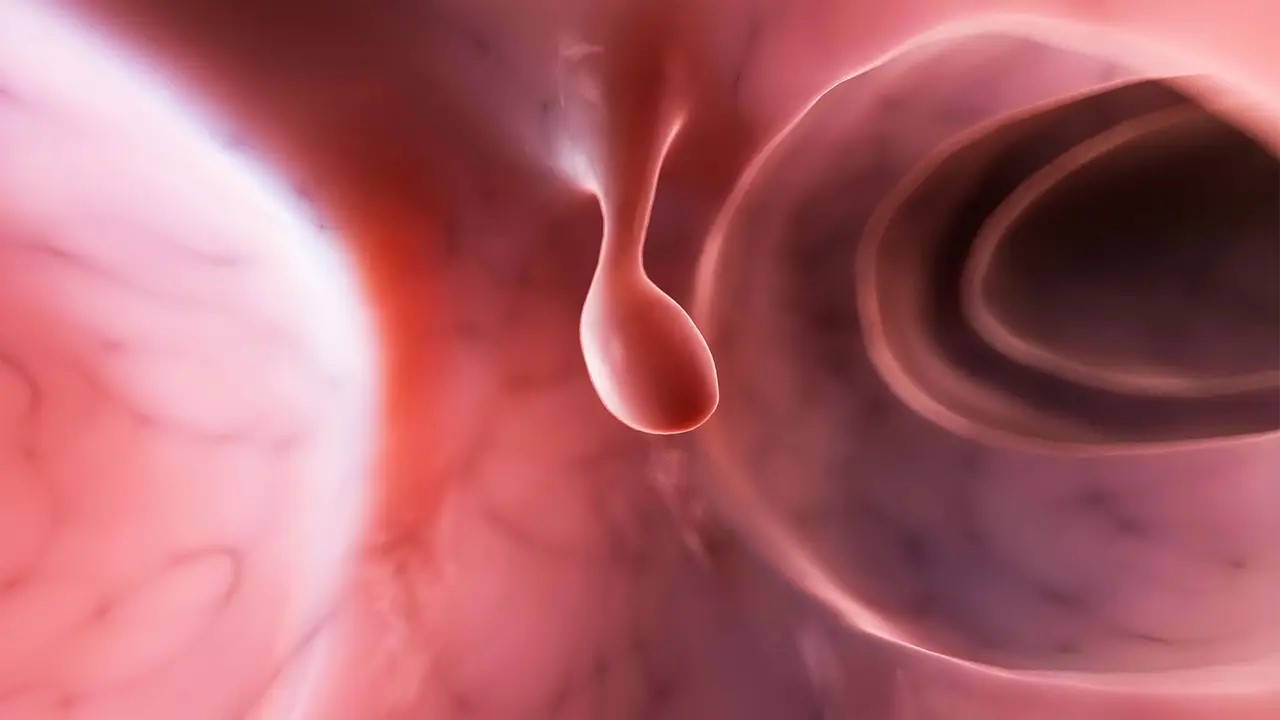 Colorectal Polyps - Understanding, Causes, and Management - TCI Hospital EN