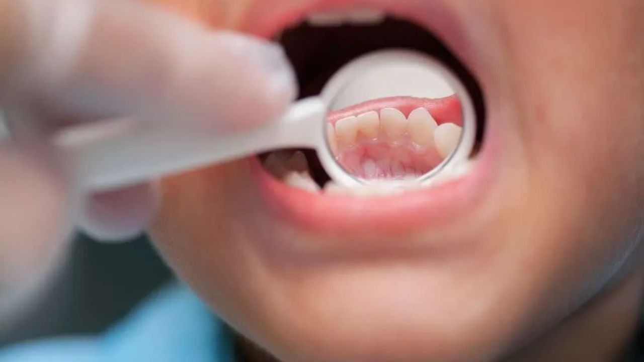 Managing Gingivitis in Children: Essential Care Tips for Parents - TCI ...