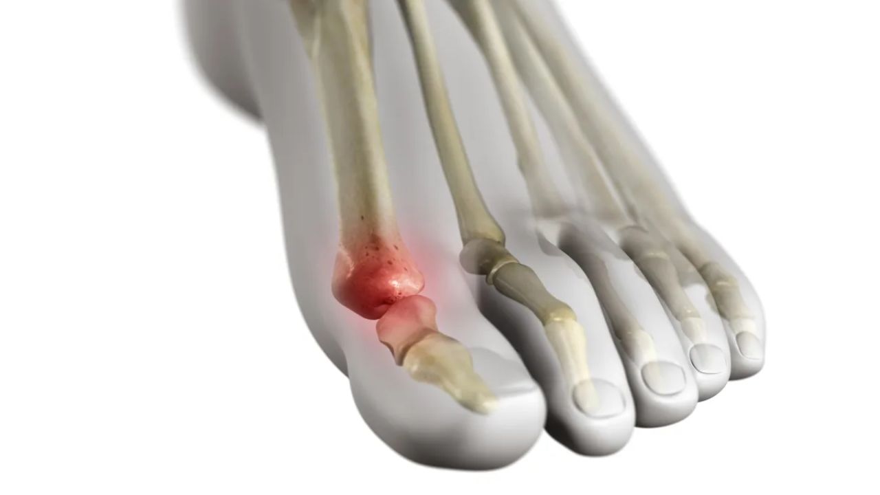 Can Gout be Cured? Understanding Gout and Effective Treatment ...