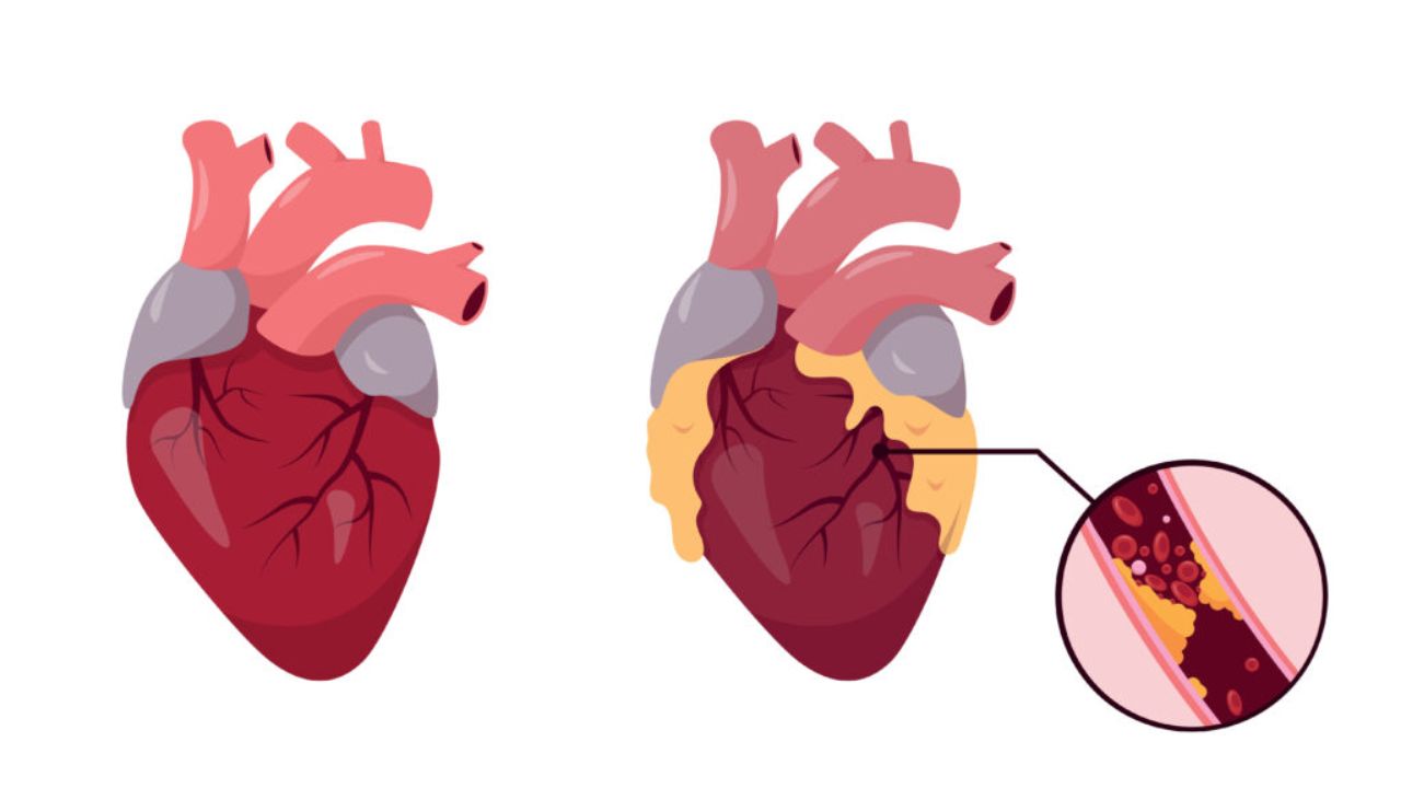 Ischemic Heart Disease - an overview - TCI Hospital EN