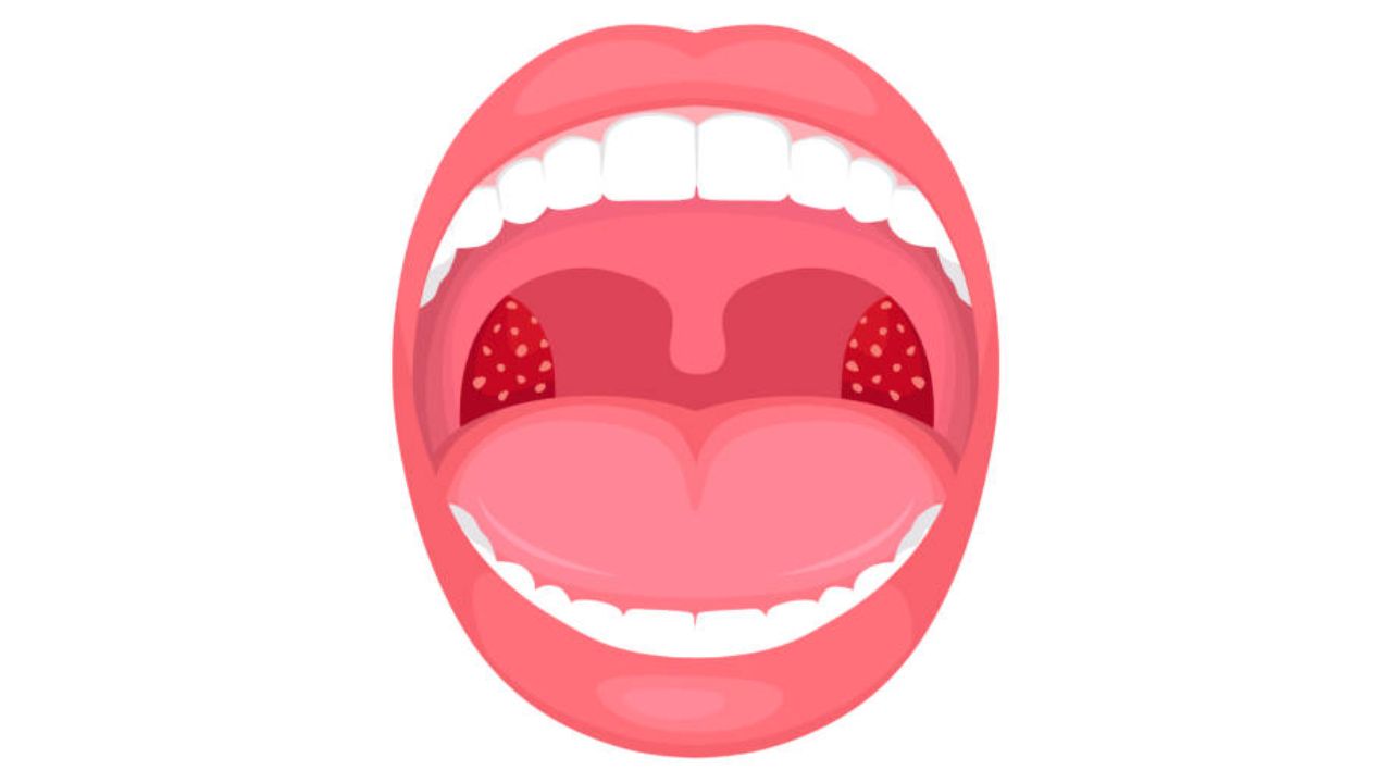 Chronic Pharyngitis with Granulation Tissue: Recognizing - Treating