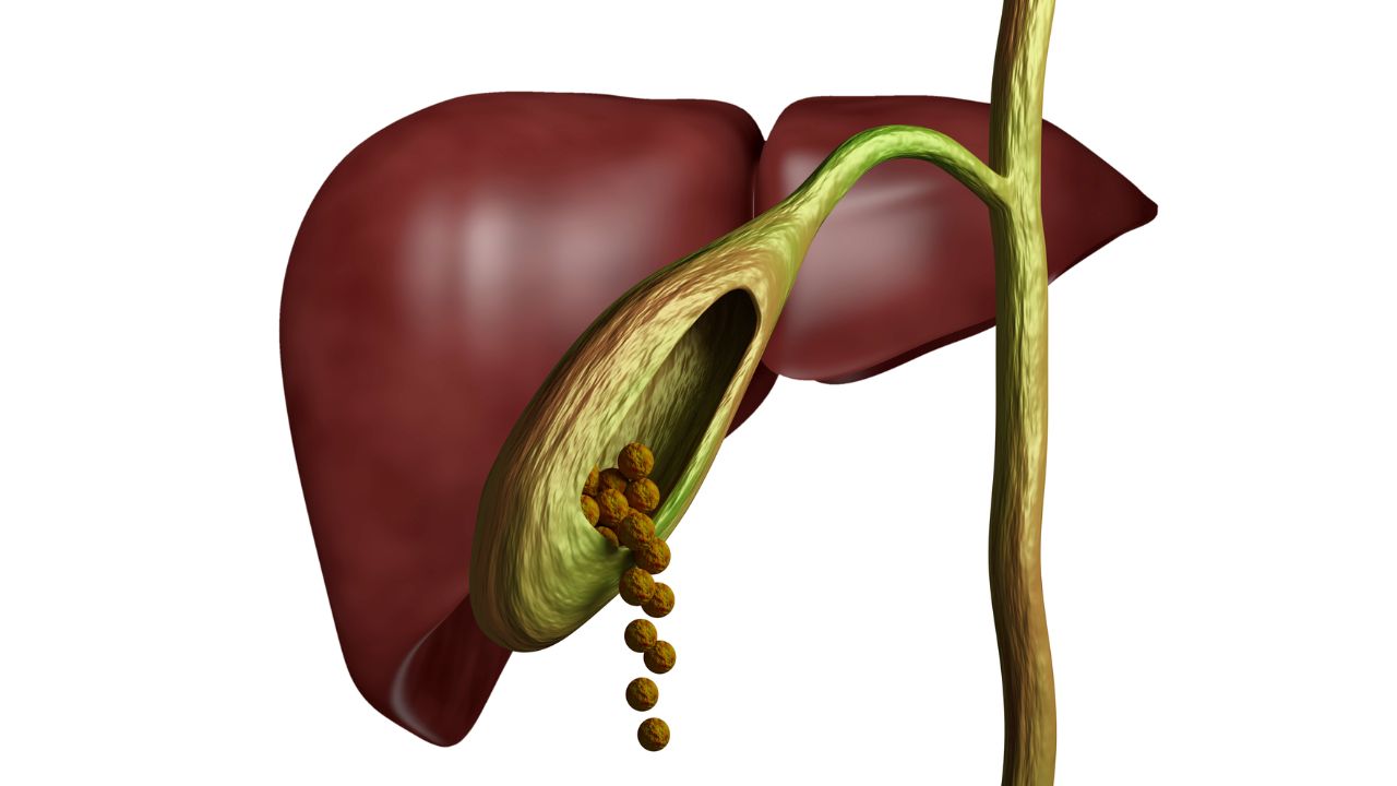 Gallbladder Stones: Essential Information Everyone Should Know - TCI ...